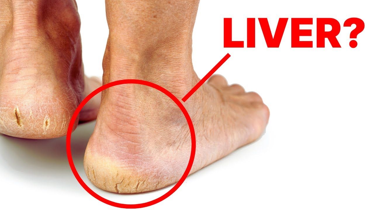 Is Your Liver Crying for Help? Check Your Feet for These Alarming Signs ...
