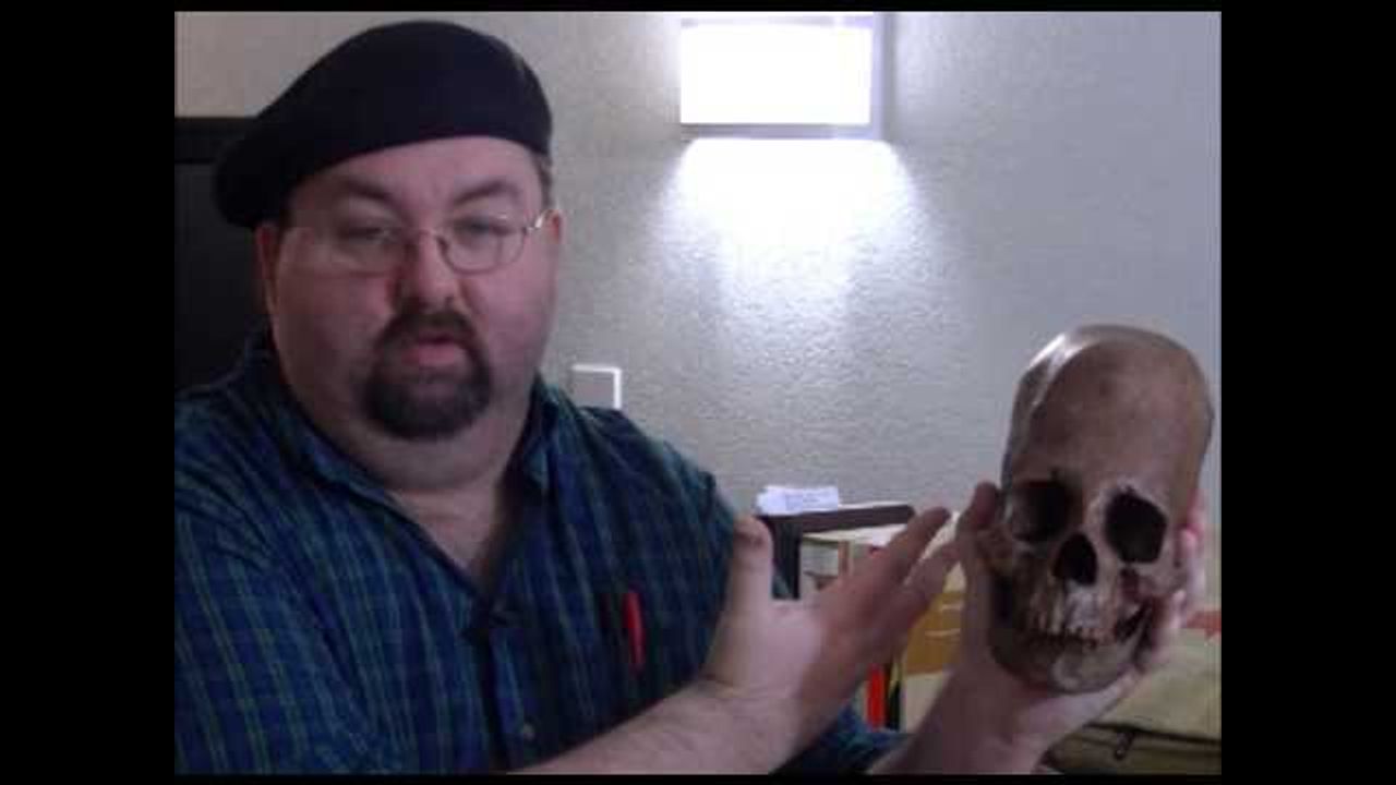 [Dec 29, 2013] Dr Judd Burton examines my conehead skull (2.8K views on ...