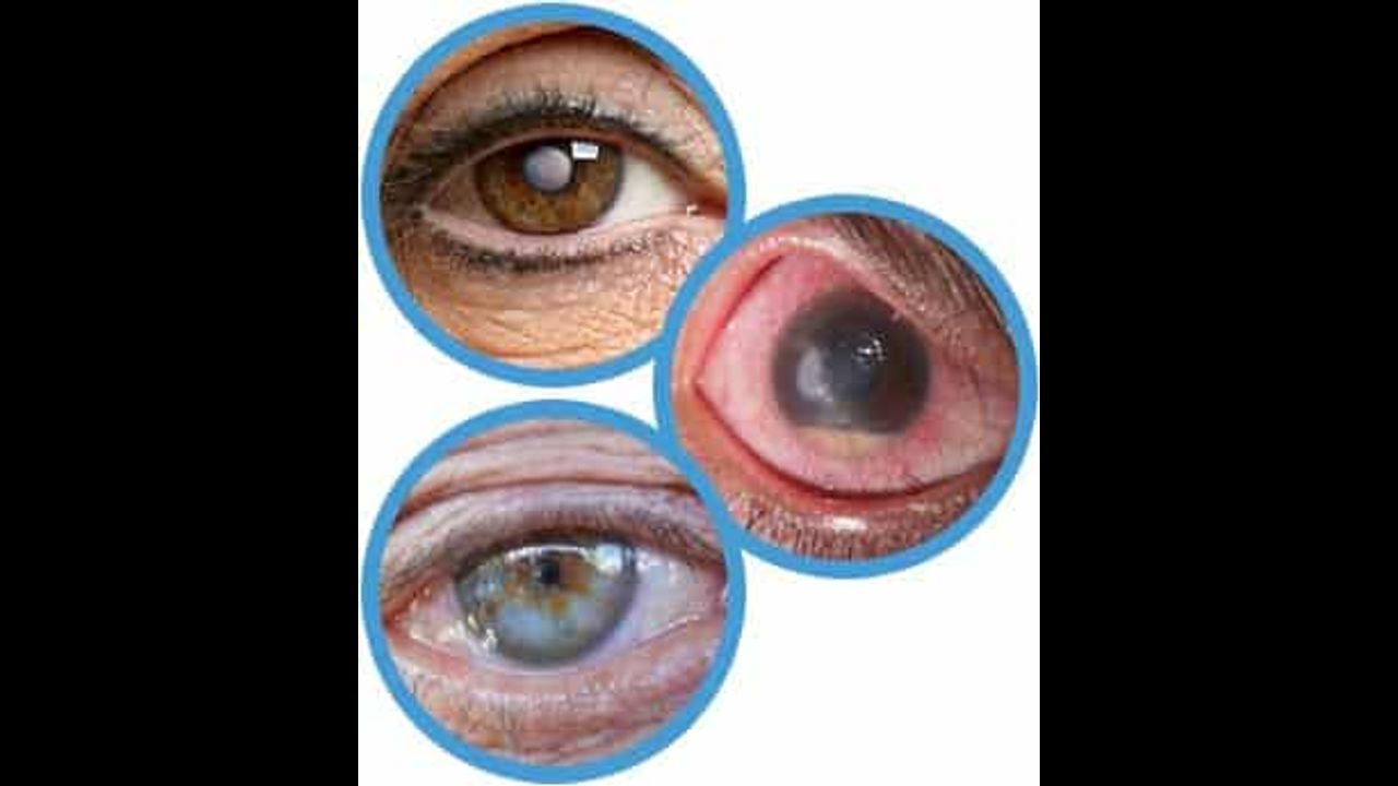 Understand the REAL Cause of Failing Or Declining Vision - Brighteon.com