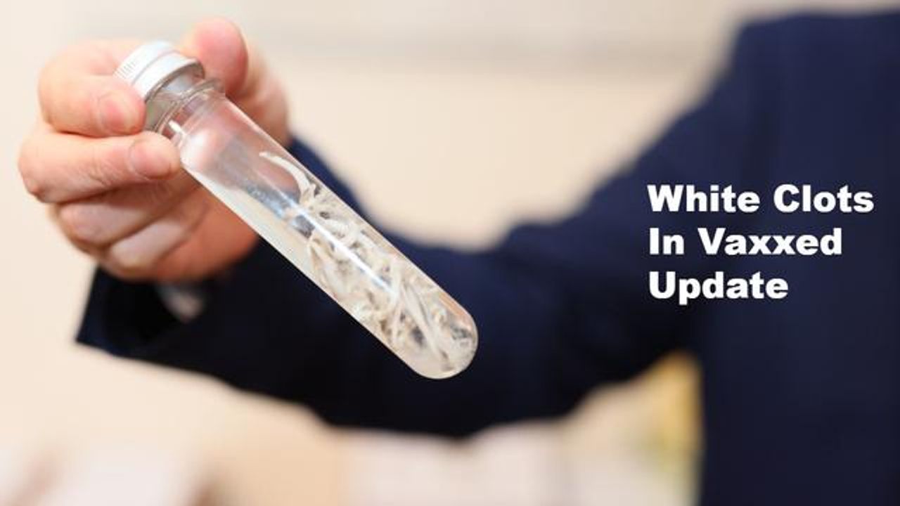 More Updates on WEIRD White Clots Forming in the Vaccinated - Brighteon.com